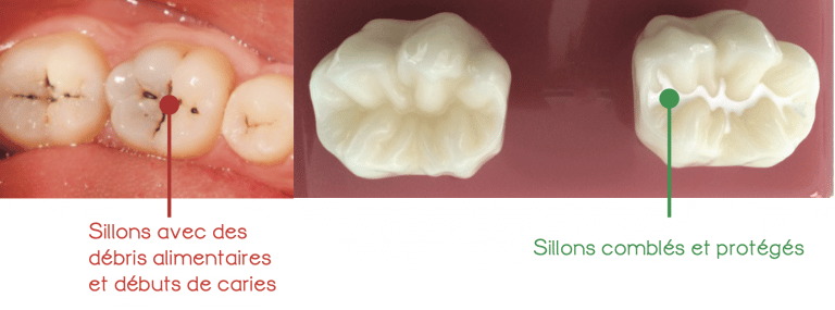 Le Scellement de Sillons - Dentiste-Enfant.com
